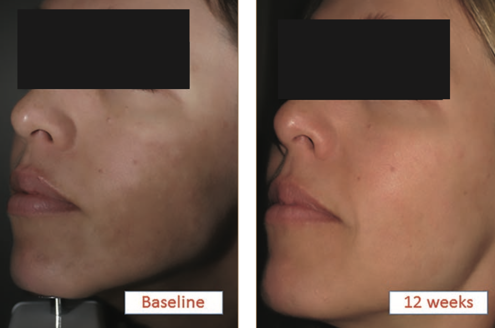 Green Led Light Therapy Melasma | Shelly Lighting