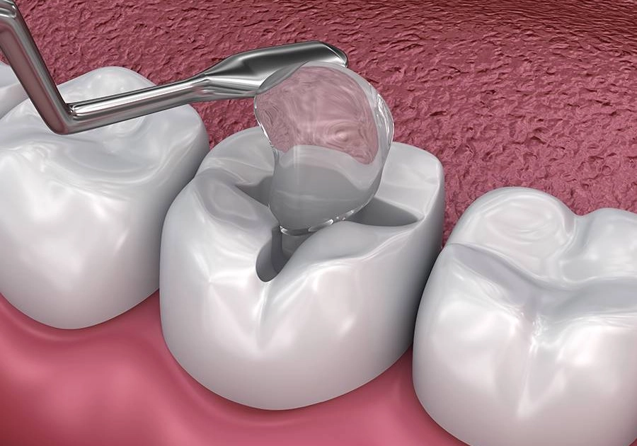 Advances in Dental Materials: What's New in Fillings and Crowns ...