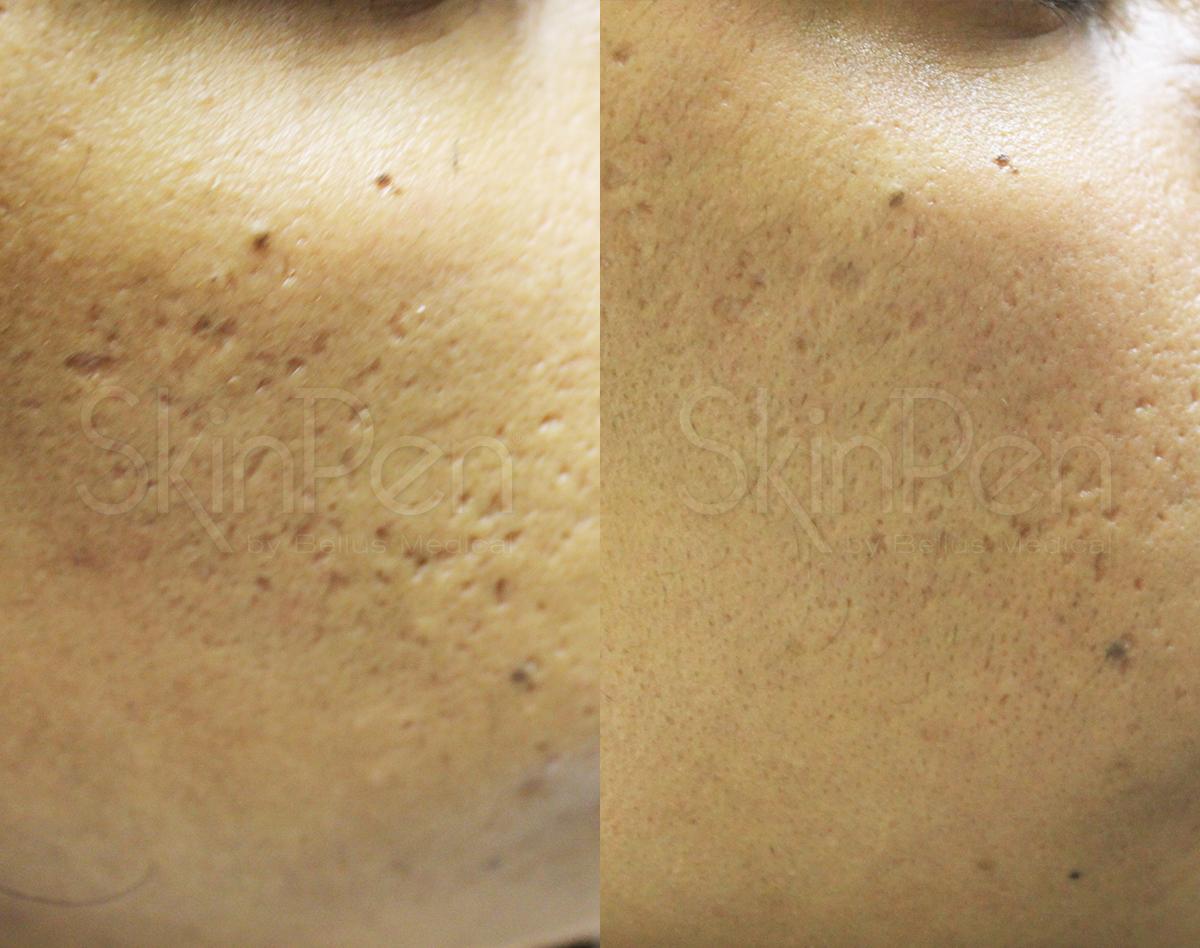 Microneedling With Calecim and SkinPen™ Precision - Acne Scars, Wrinkle ...
