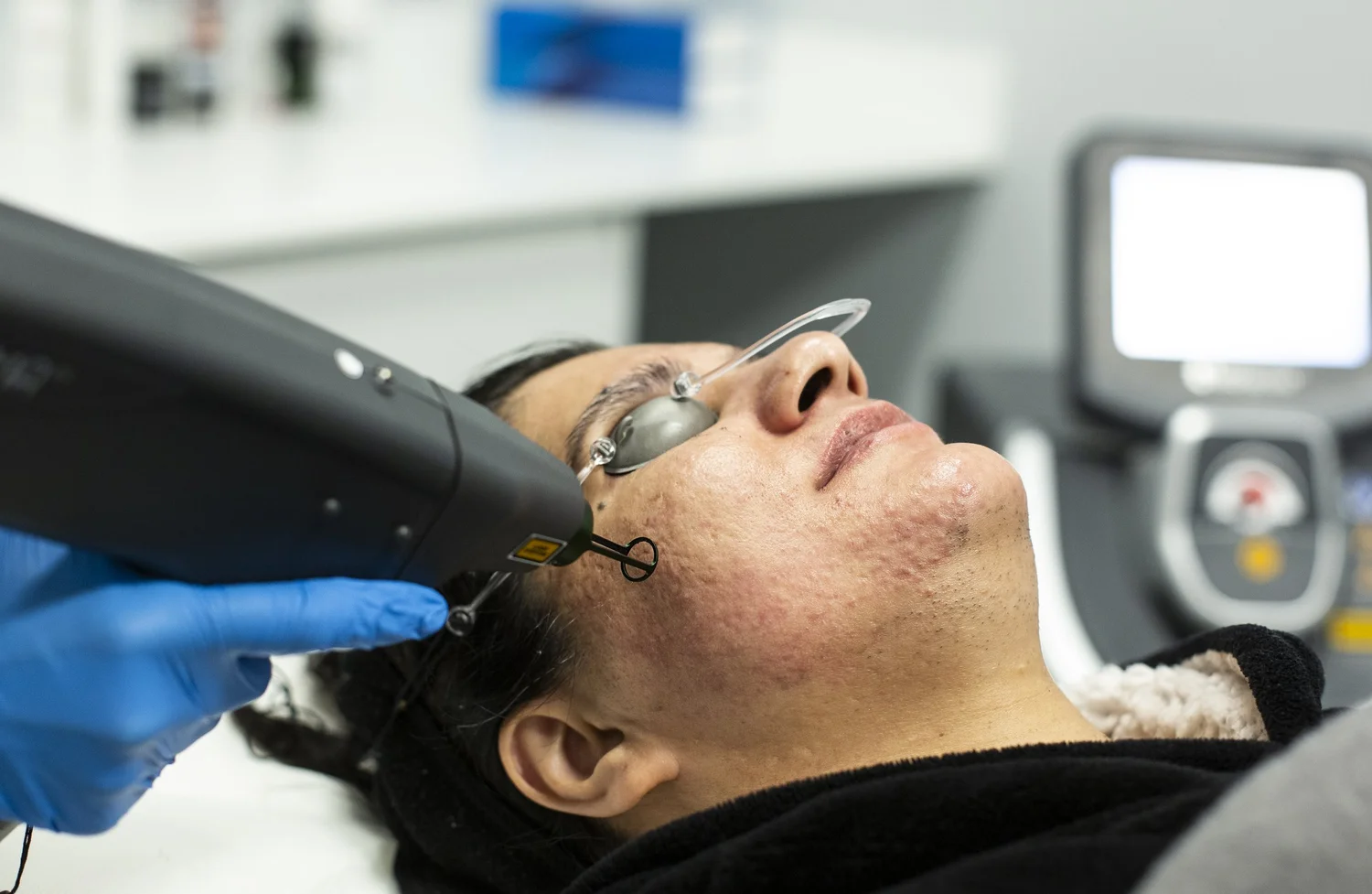 Acroma Melasma Laser Treatments In Oxford — Lumiere Medispa - Skin ...