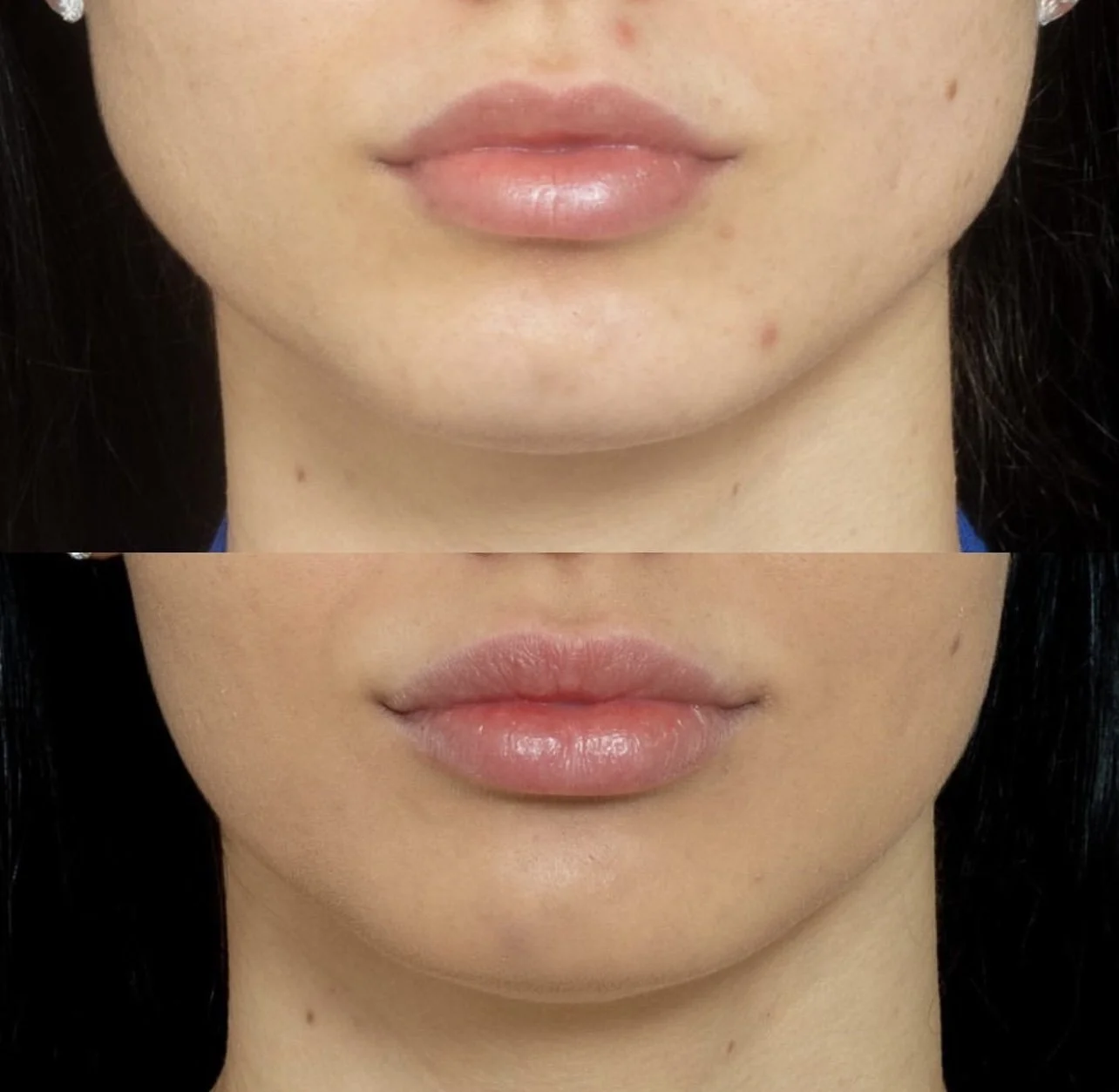 Jaw Slimming — Northern Skin Studio