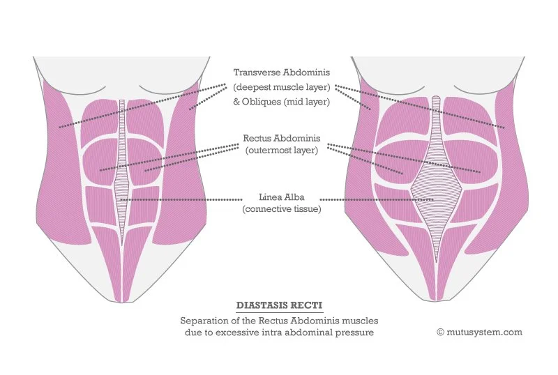 Diastasis Recti