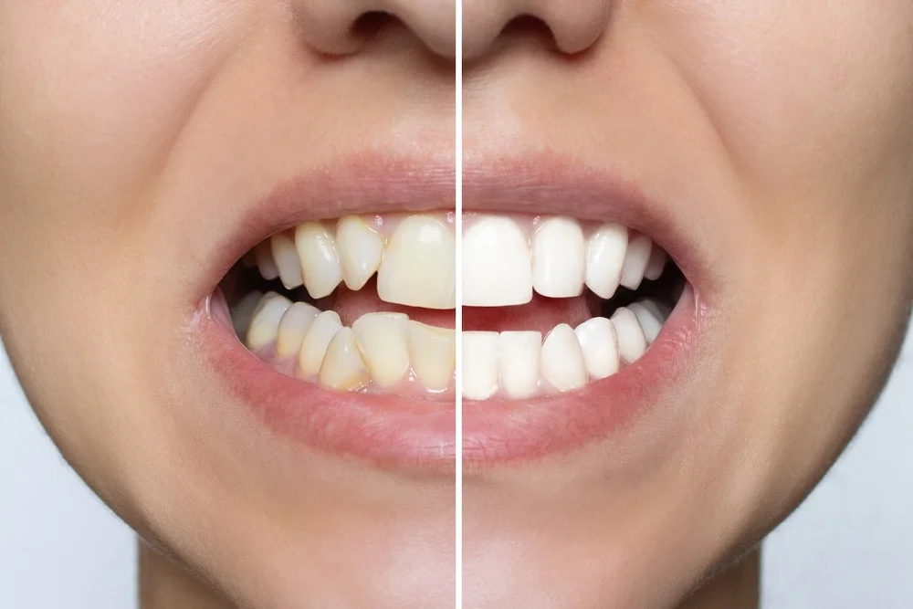 Composite Bonding vs Veneers - The Dental Spa