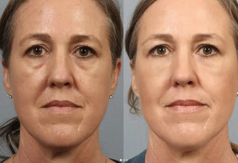 What Does Microneedling Do? - The Dental Spa