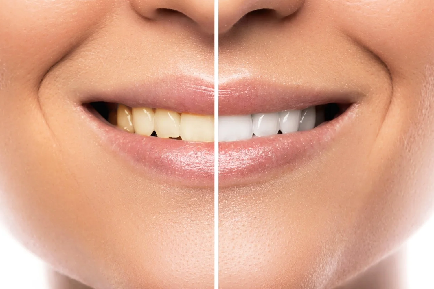 Teeth Whitening Statistics 2024 | The Dental Spa - The Dental Spa