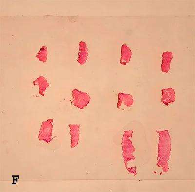 Frozen Block Embedding II — Pathology Innovations