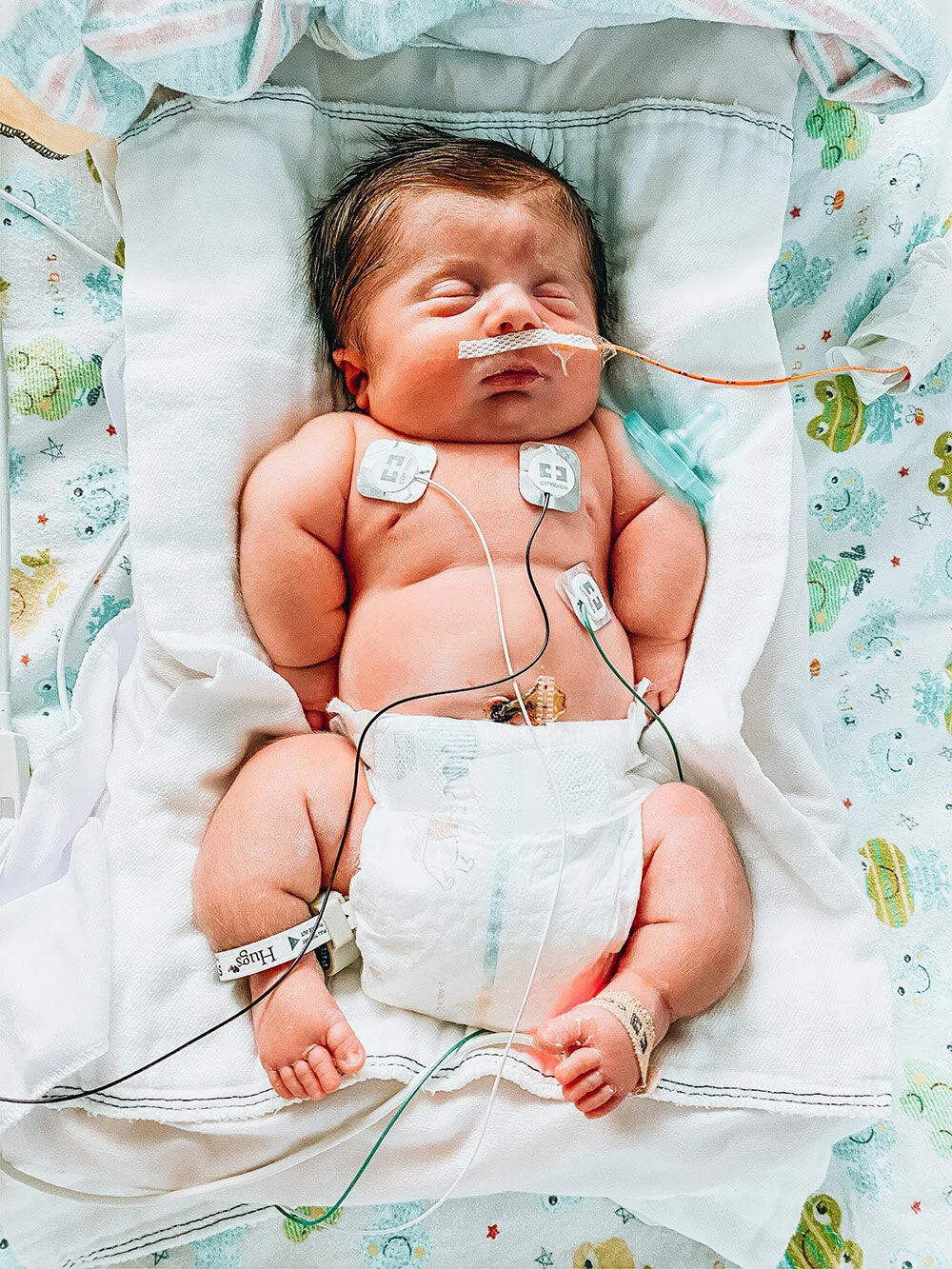 Osteogenesis Imperfecta Baby