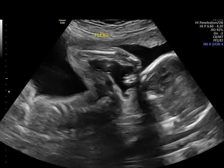 23 Weeks Ultrasound Boy