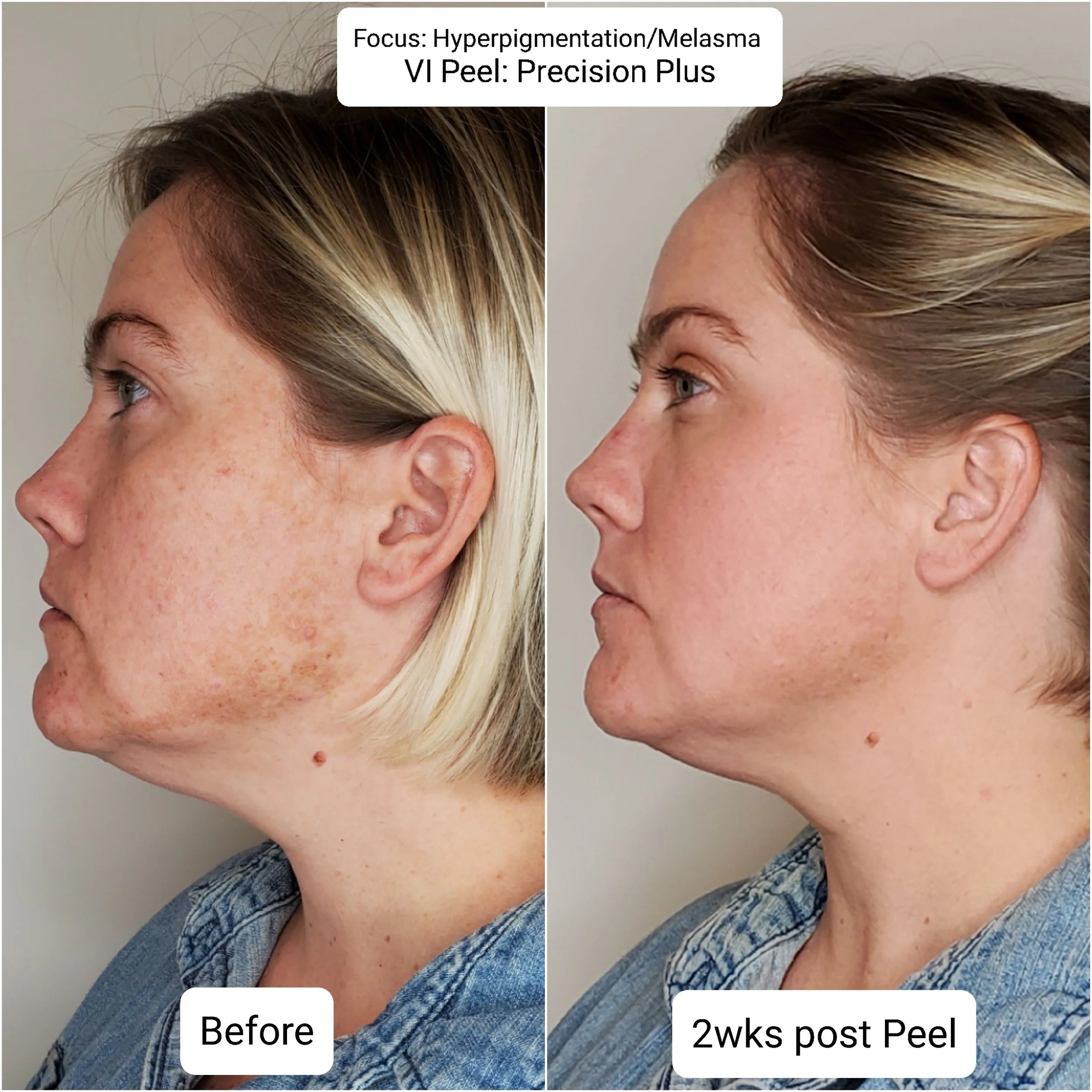 VI Peels — HAUS Salon