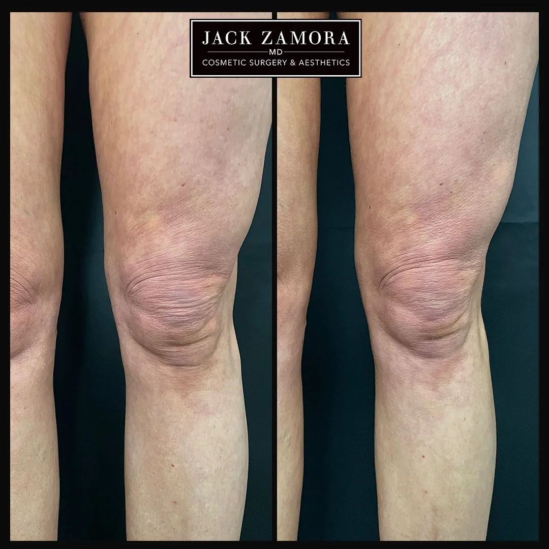Jack Zamora MD Cosmetic Surgery and Aesthetics - ATTIVA RF