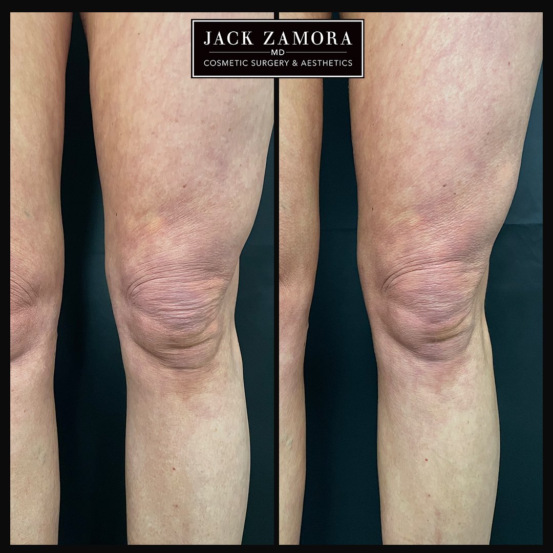 Jack Zamora MD Cosmetic Surgery and Aesthetics - ATTIVA RF