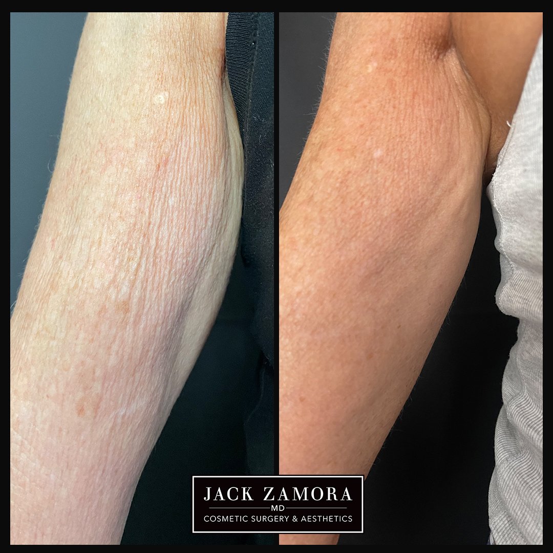 Jack Zamora MD Cosmetic Surgery and Aesthetics - ATTIVA RF