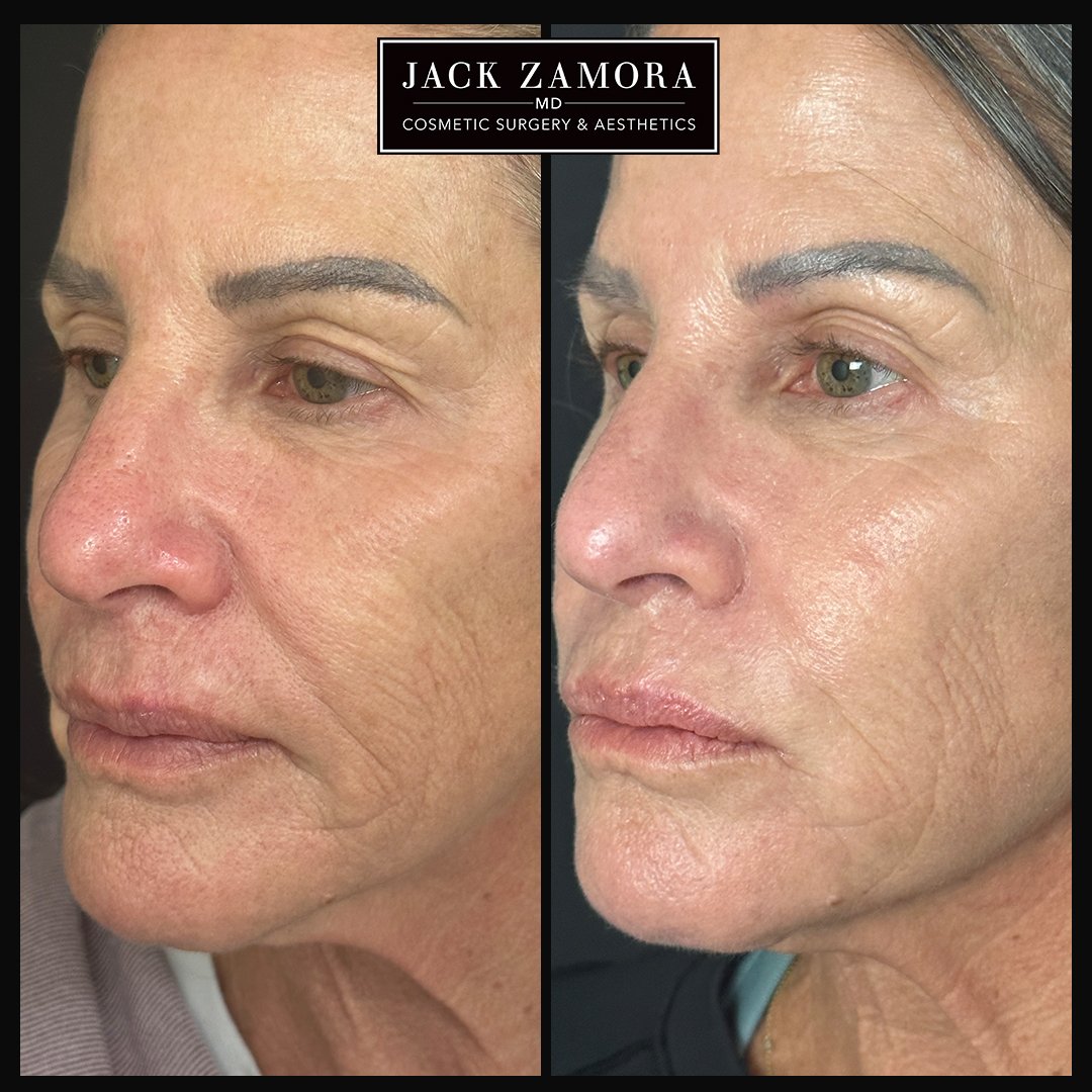 Jack Zamora MD Cosmetic Surgery and Aesthetics - ATTIVA RF