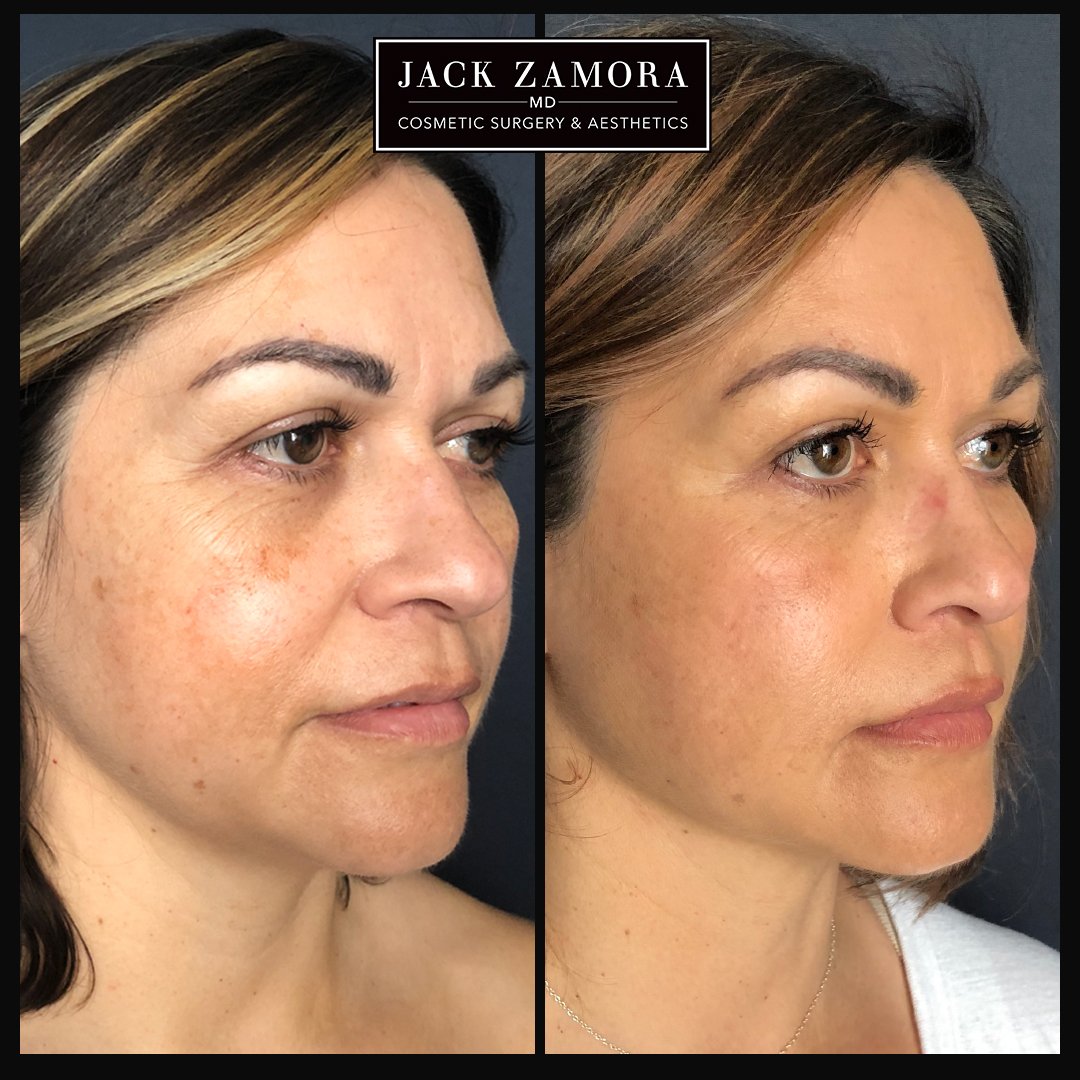 Trending for 2024 — Jack Zamora MD Cosmetic Surgery and Aesthetics