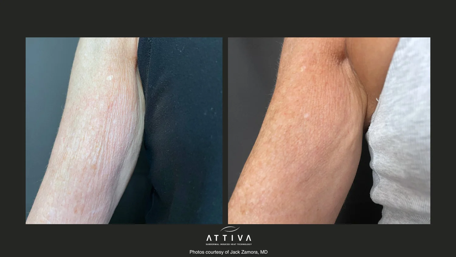 Jack Zamora MD Cosmetic Surgery and Aesthetics - ATTIVA iRF Treatment ...