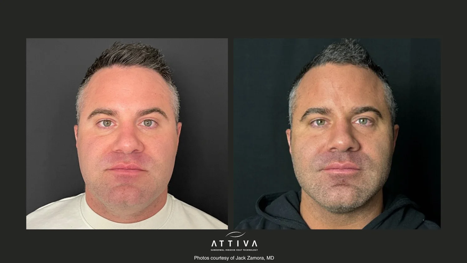 Jack Zamora MD Cosmetic Surgery and Aesthetics - ATTIVA iRF Treatment ...
