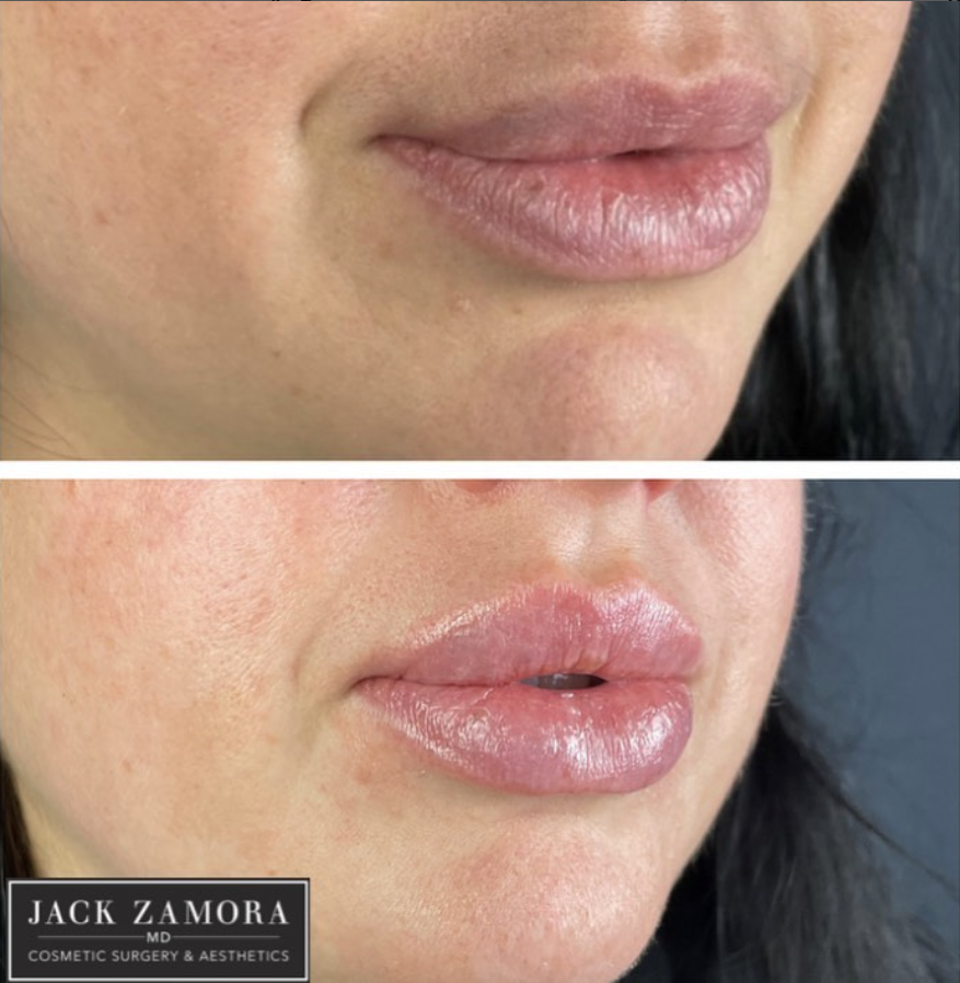 Jack Zamora MD Cosmetic Surgery and Aesthetics - Juvederm Filler in Denver, Colorado