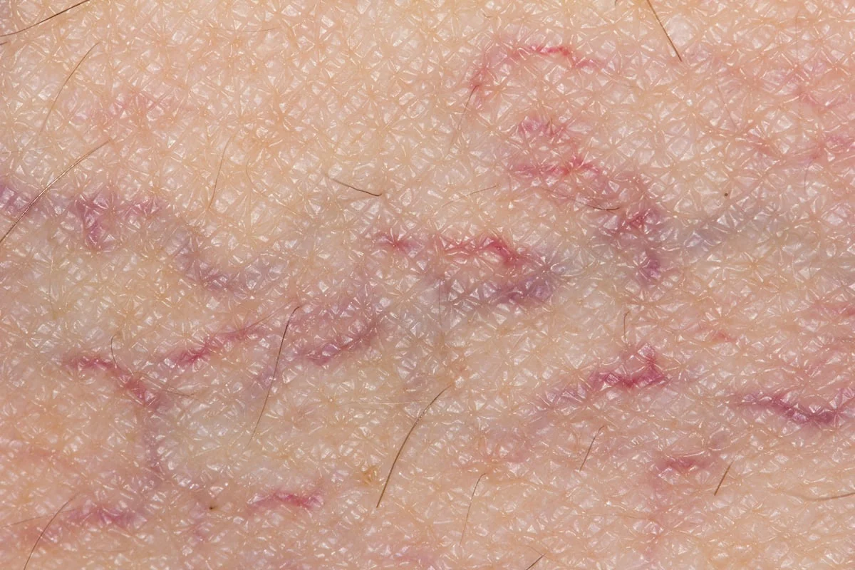 Blood Vessels In Skin