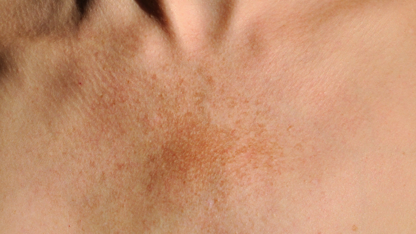 Pigmentation Treatment — The Dermatology Institute of Victoria ...