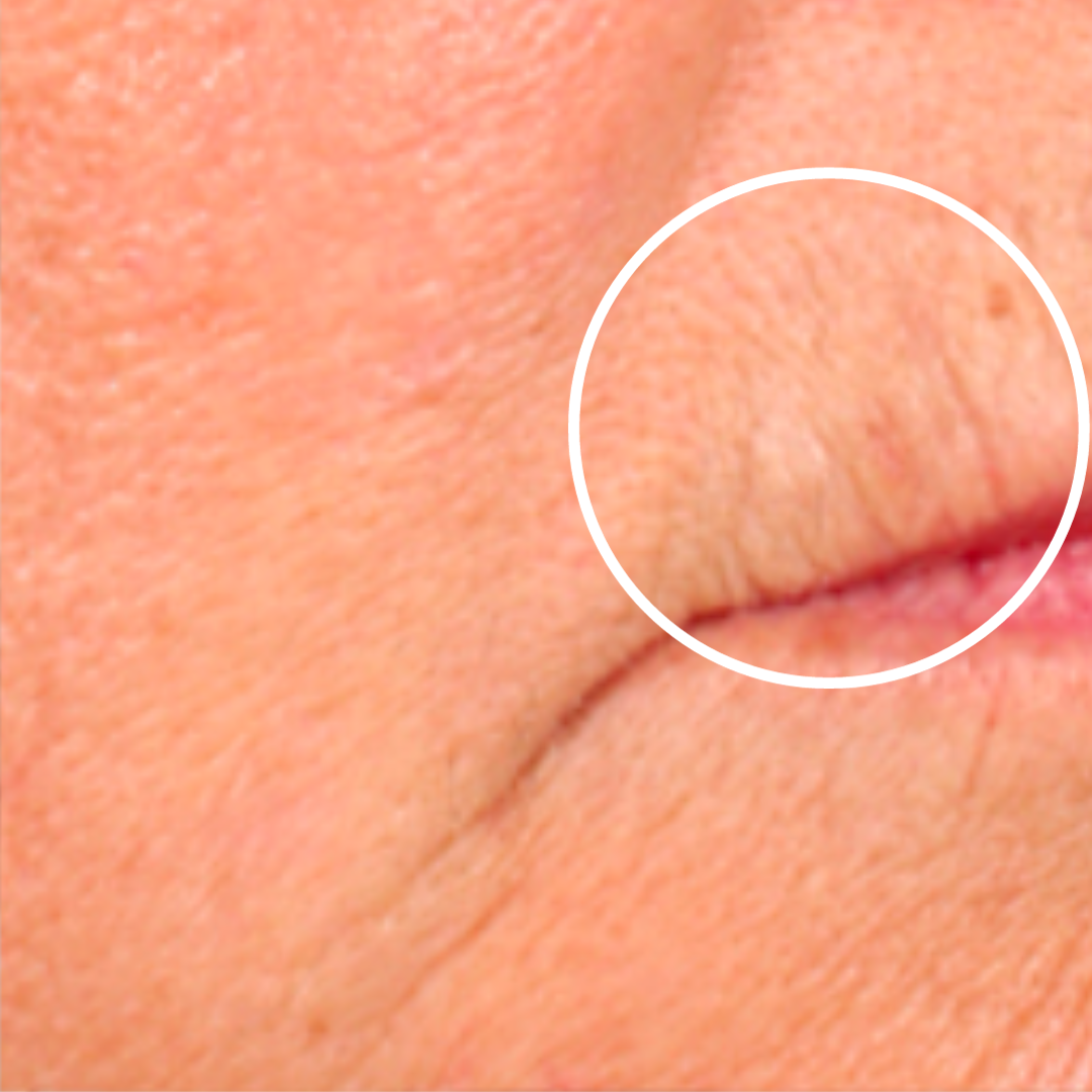 Erbium resurfacing laser at the Dermatology Institute of Victoria ...