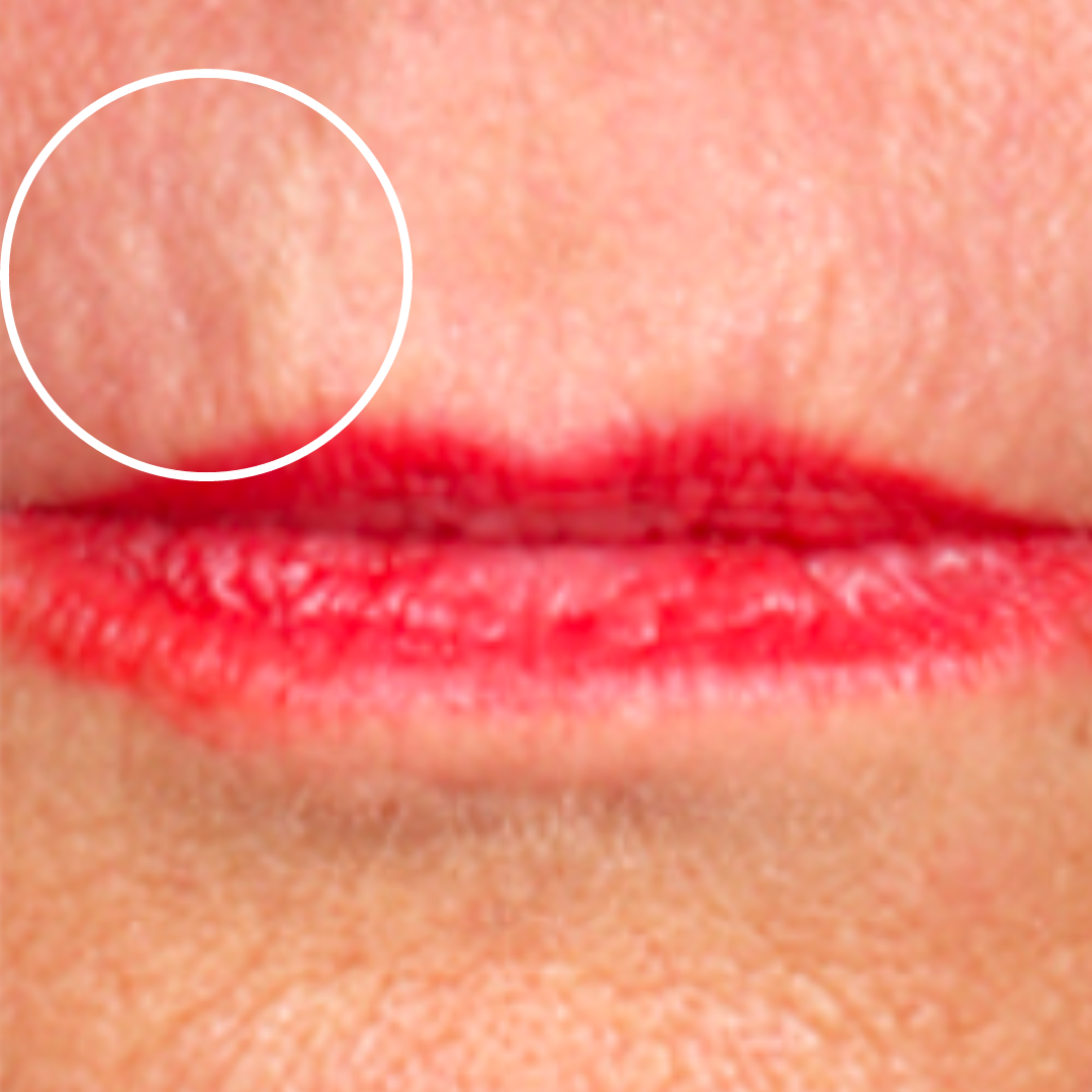 Erbium resurfacing laser at the Dermatology Institute of Victoria ...