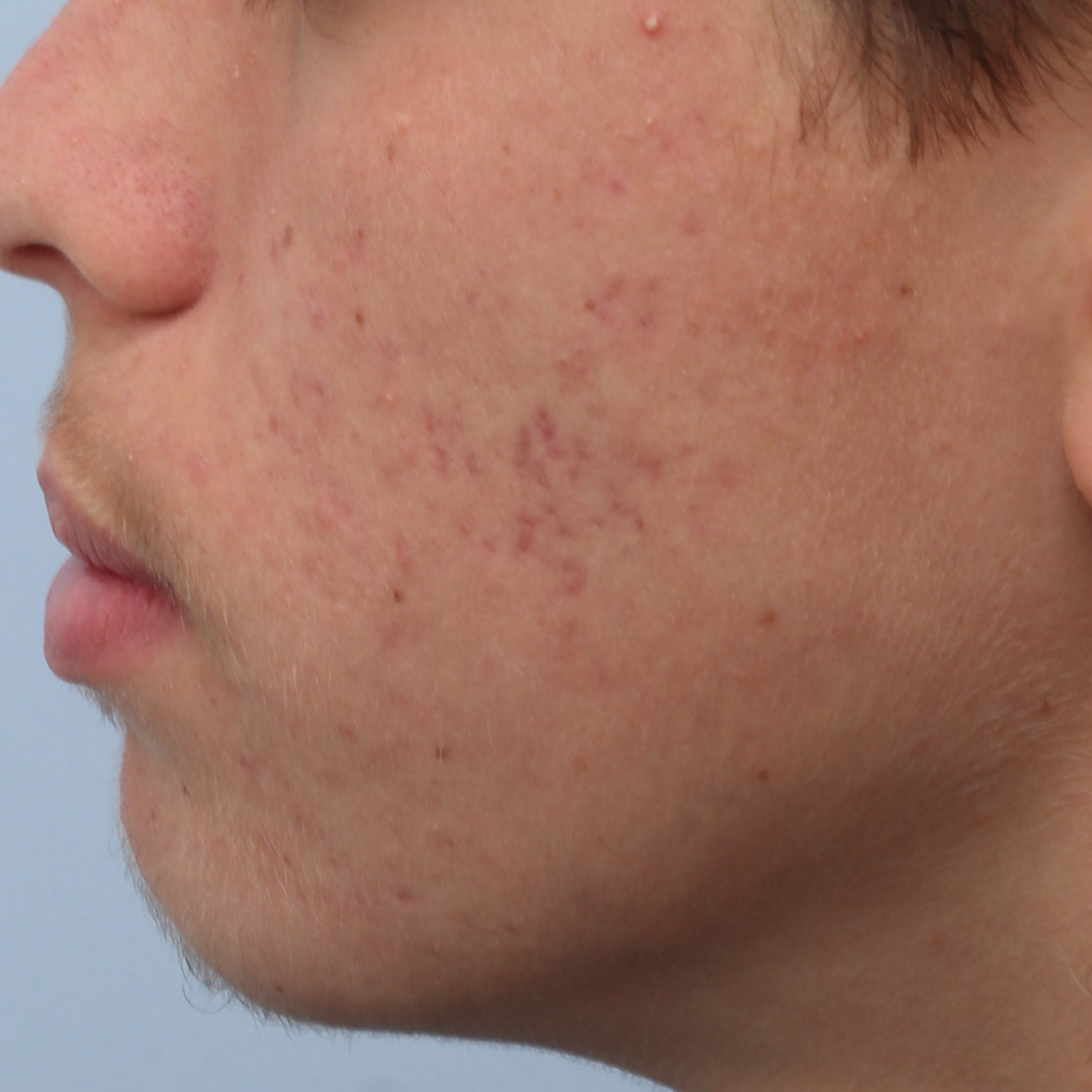 Kleresca® — The Dermatology Institute of Victoria | Melbourne ...