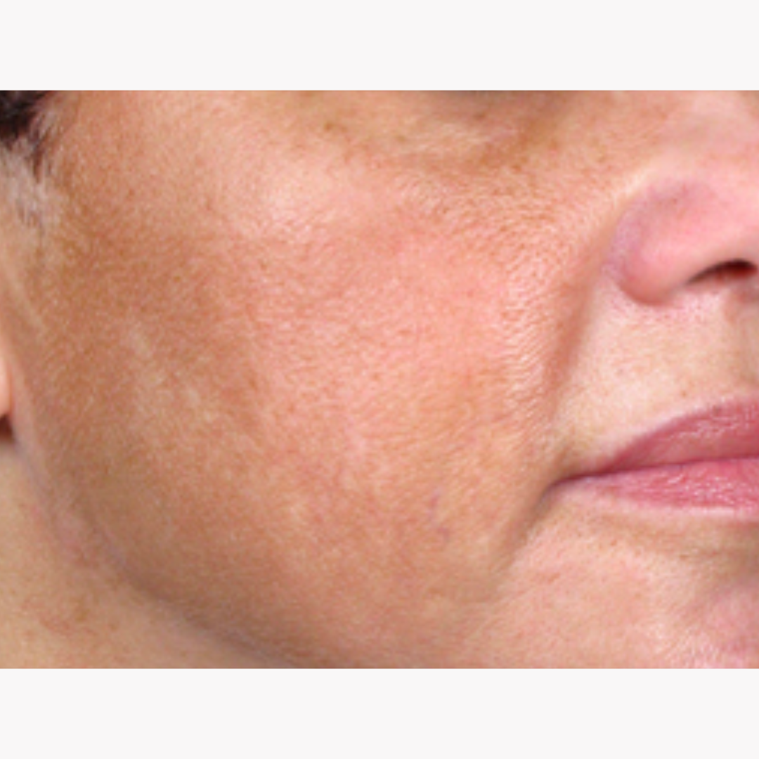 Skin peels at the Dermatology Institute of Victoria Melbourne — The ...