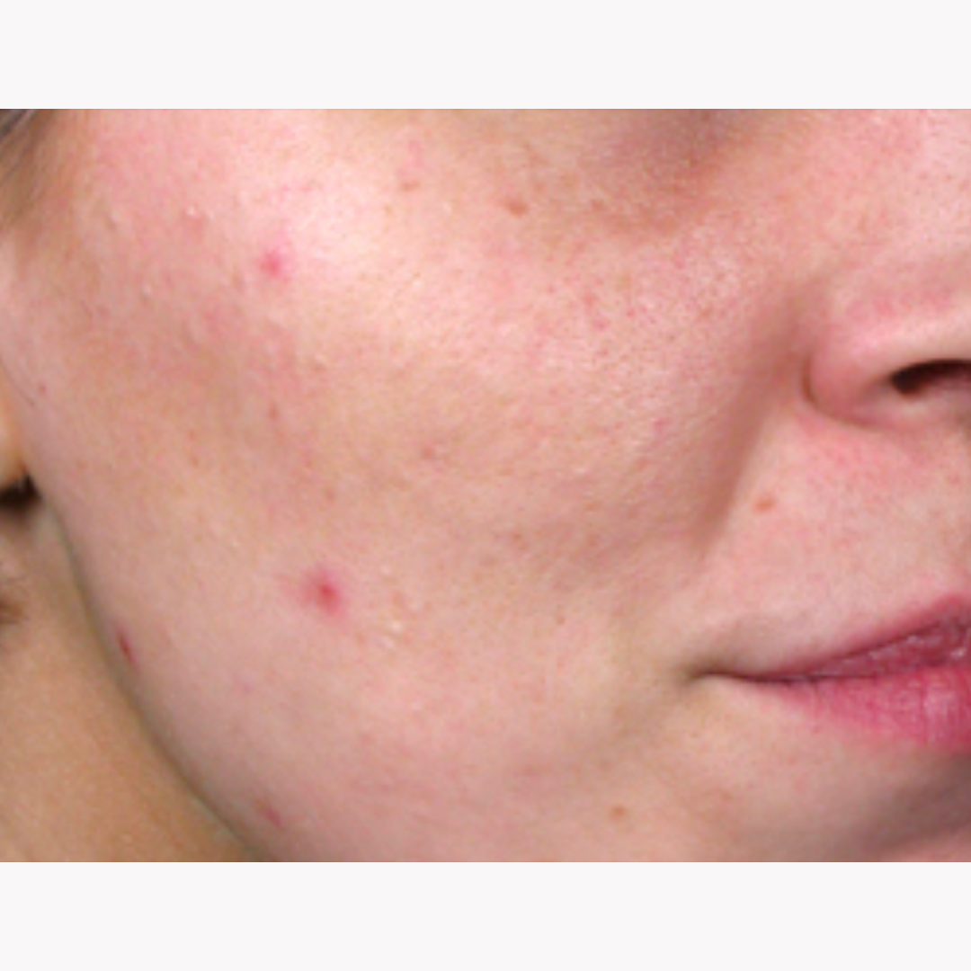 Skin peels at the Dermatology Institute of Victoria Melbourne — The ...