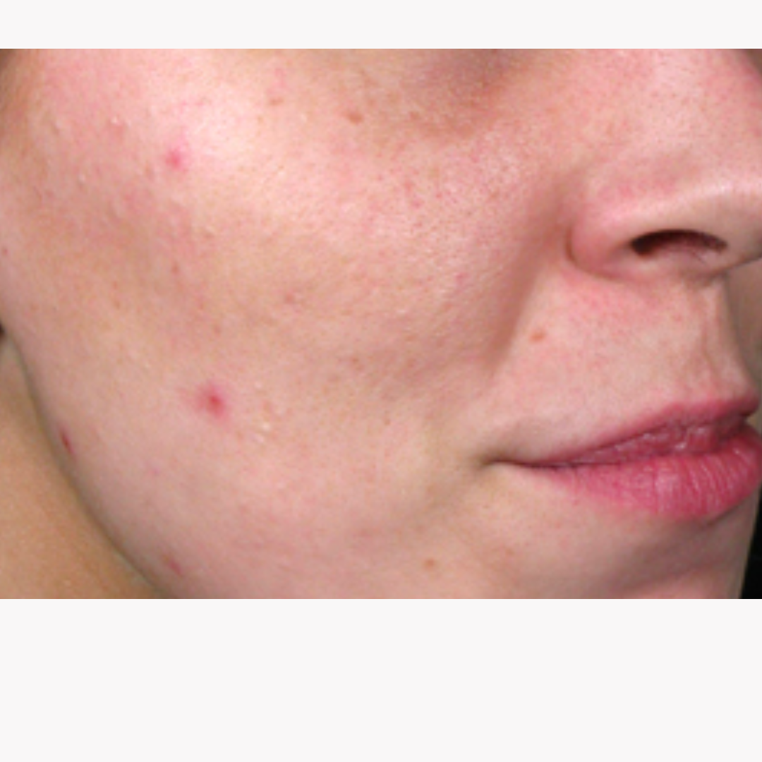 Skin Needling Treatment — The Dermatology Institute of Victoria ...