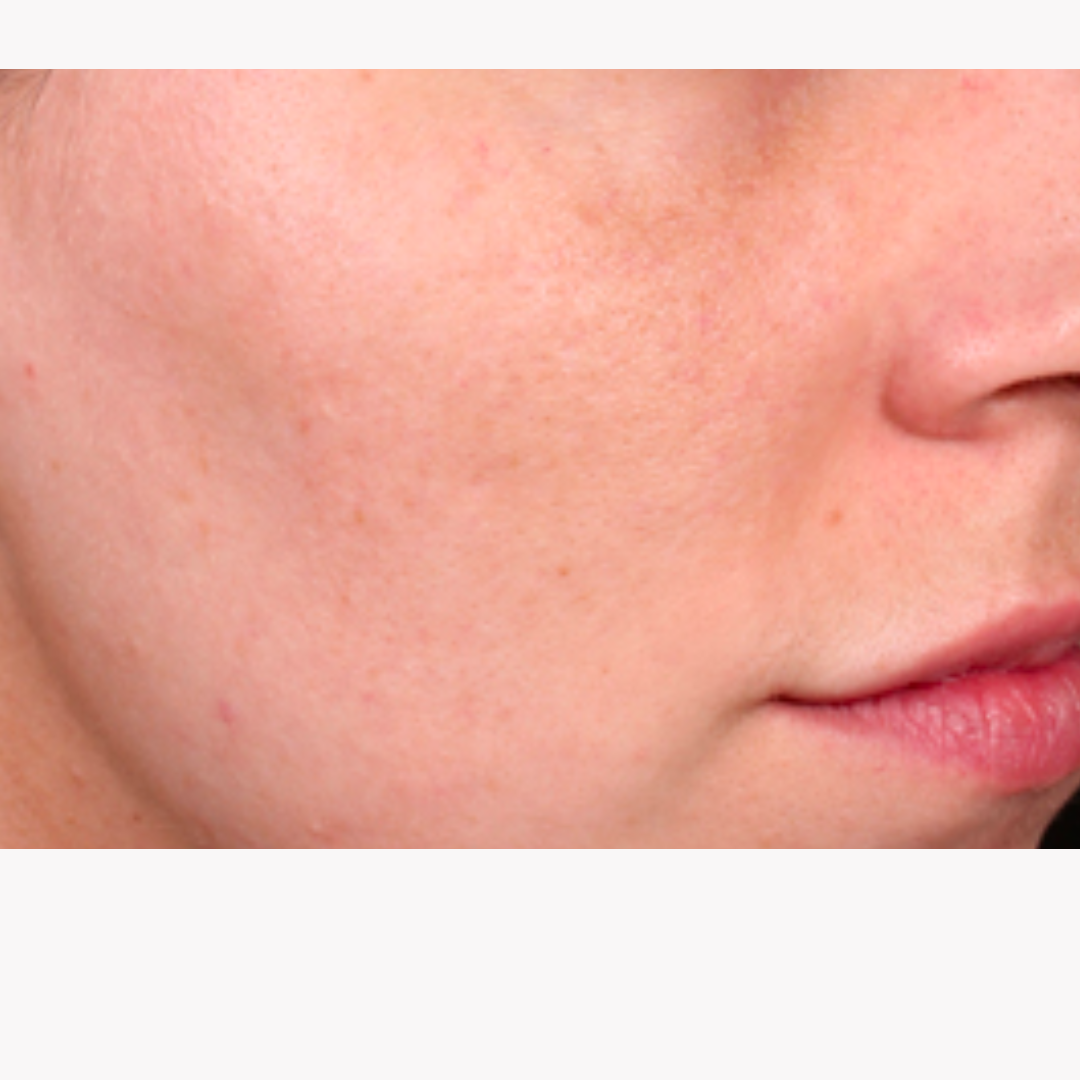 Skin Needling Treatment — The Dermatology Institute of Victoria ...