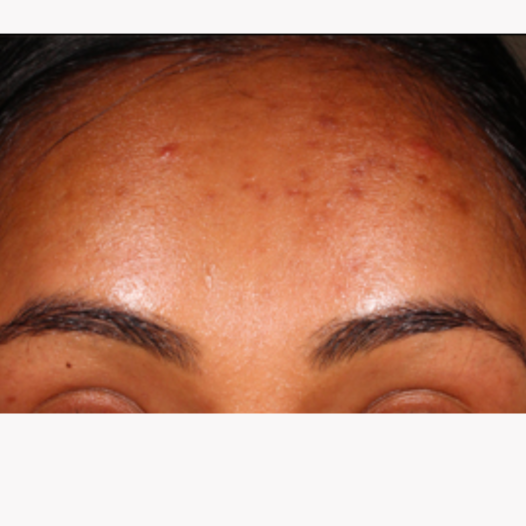 Skin Needling Treatment — The Dermatology Institute of Victoria ...