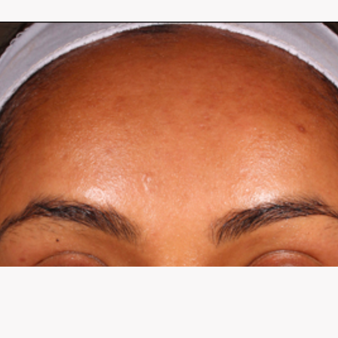 Skin Needling Treatment — The Dermatology Institute of Victoria ...