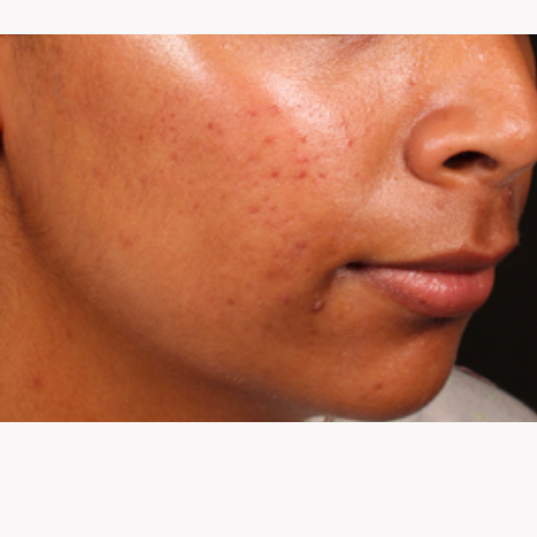 Skin Needling Treatment — The Dermatology Institute of Victoria ...