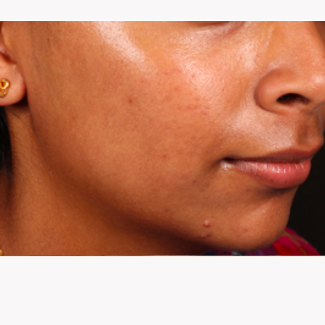 Skin Needling Treatment — The Dermatology Institute of Victoria ...