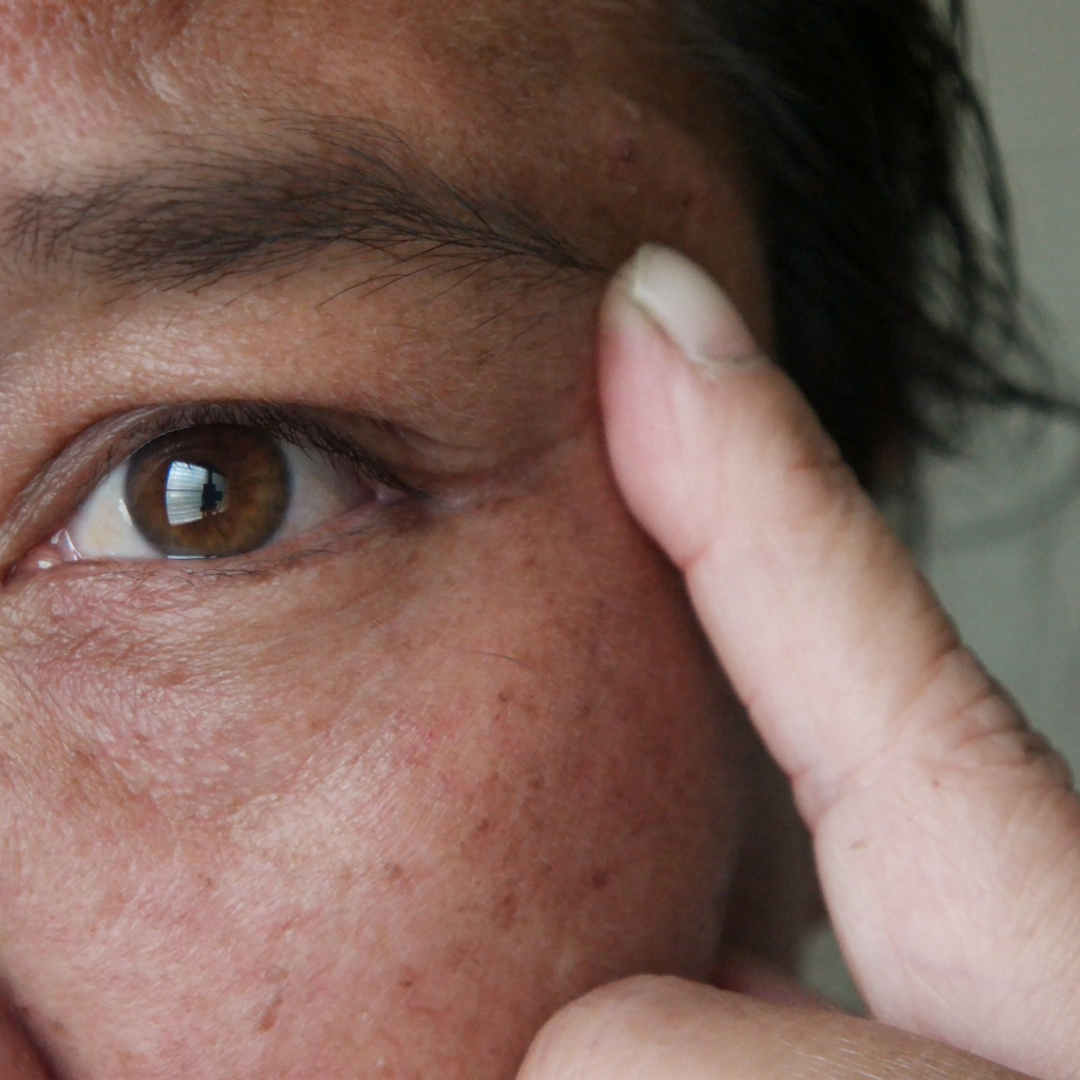 How to treat Pigmentation at the Dermatology Institute of Victoria ...