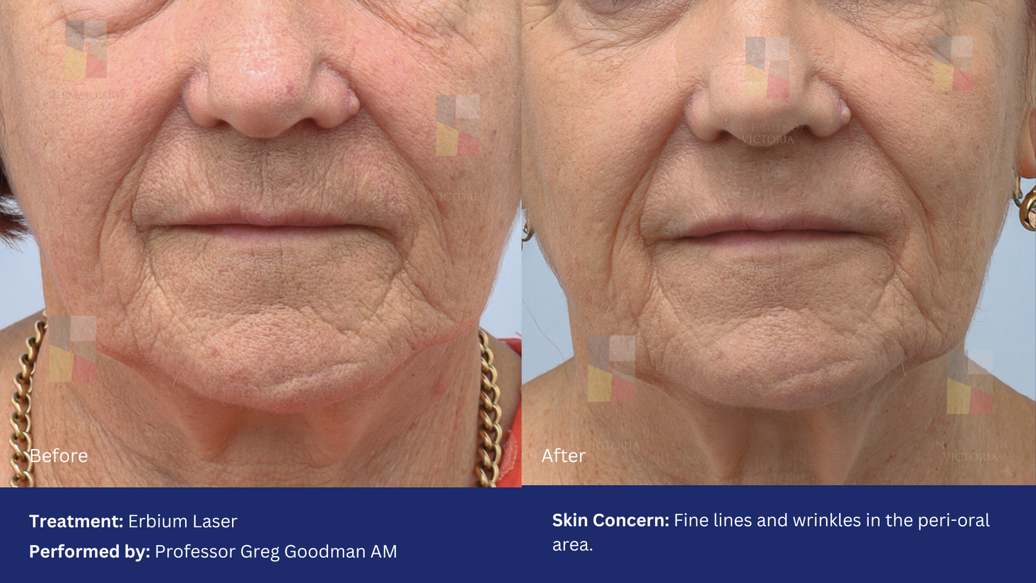 Erbium resurfacing laser at the Dermatology Institute of Victoria ...