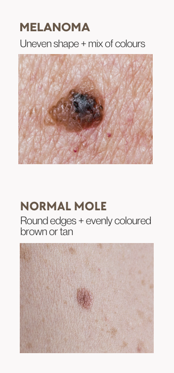 Skin Cancer — The Dermatology Institute of Victoria | Melbourne ...