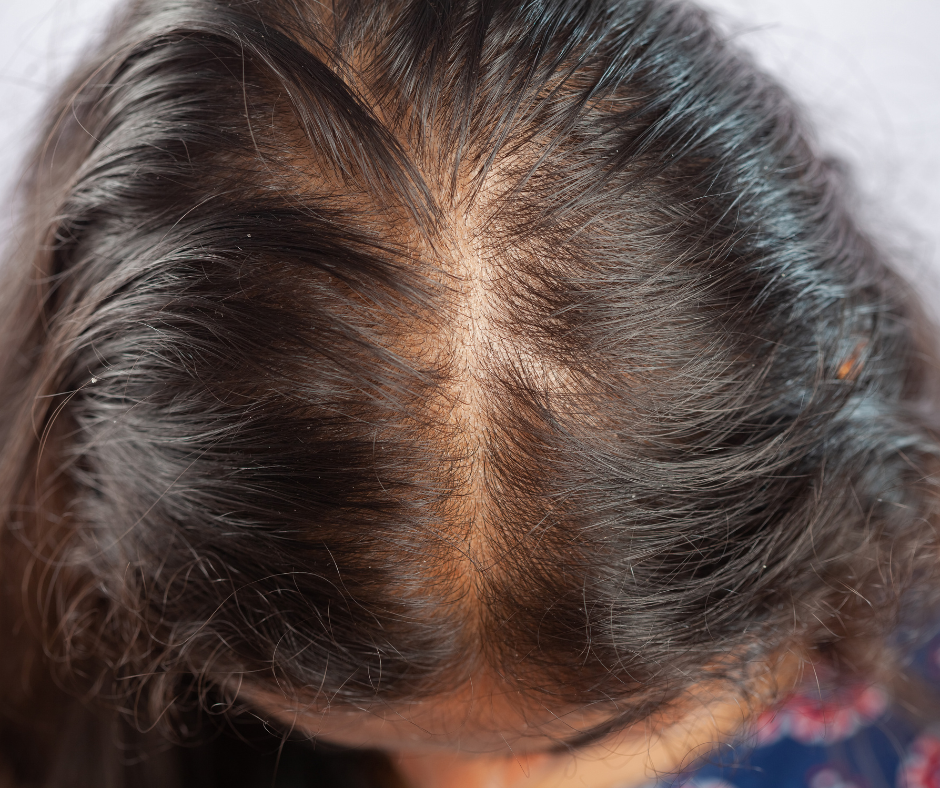 Hair Loss Treatment Melbourne — The Dermatology Institute of Victoria ...
