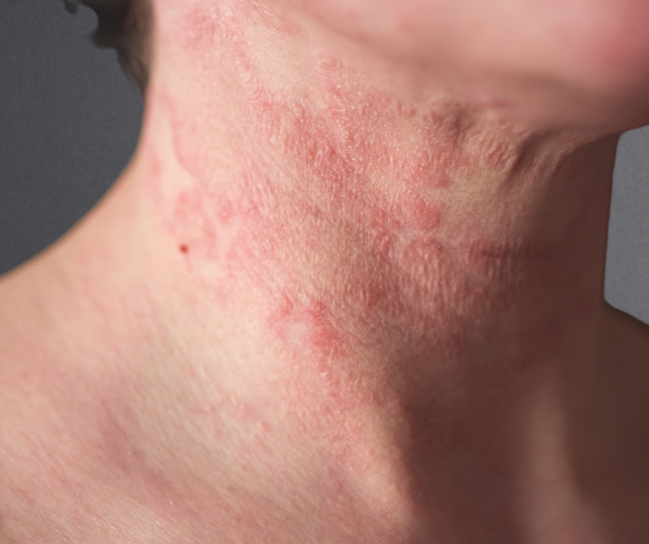 Eczema and Psoriasis Treatments Melbourne — The Dermatology Institute ...