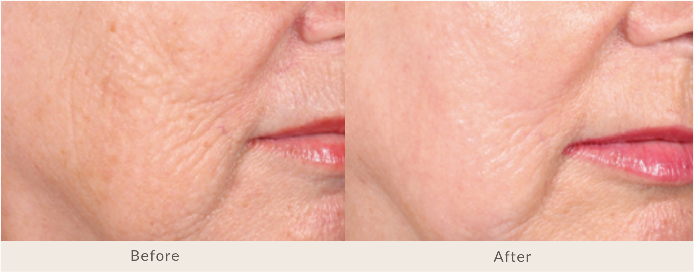 Skin Tightening and Contouring — The Dermatology Institute of Victoria ...