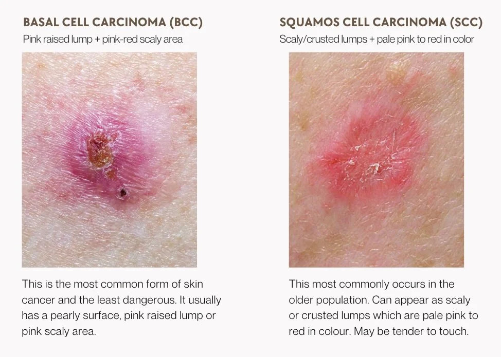 Skin Cancer — The Dermatology Institute of Victoria | Melbourne ...