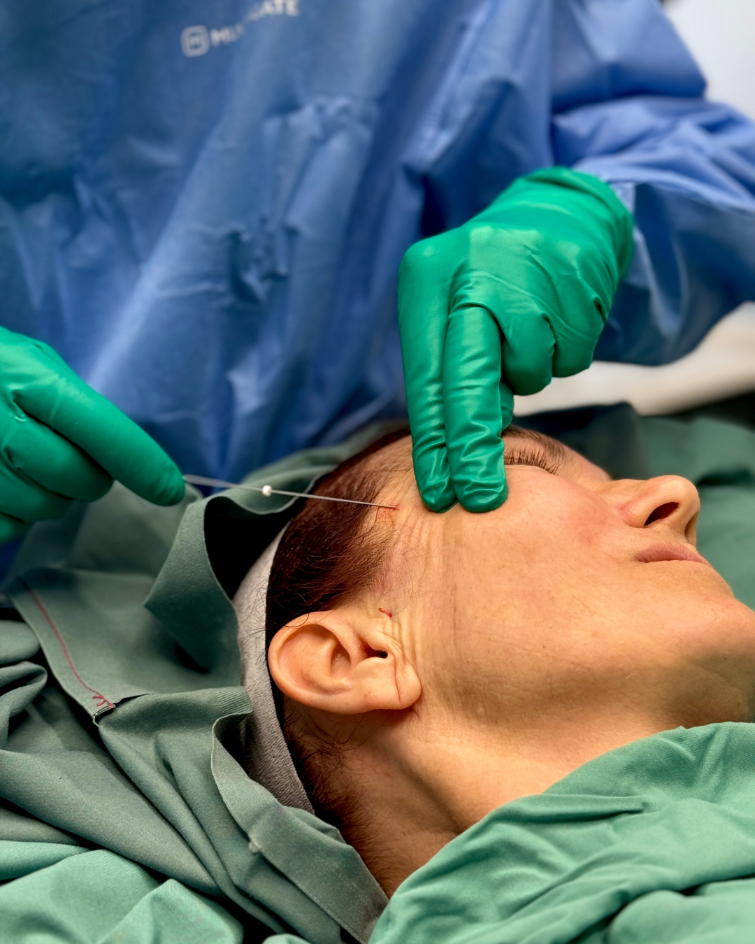 Suture Lifting — The Dermatology Institute of Victoria | Melbourne ...