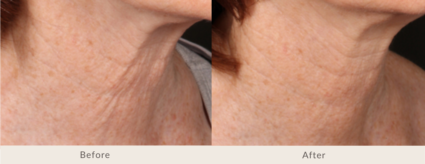 Skin Tightening and Contouring — The Dermatology Institute of Victoria ...