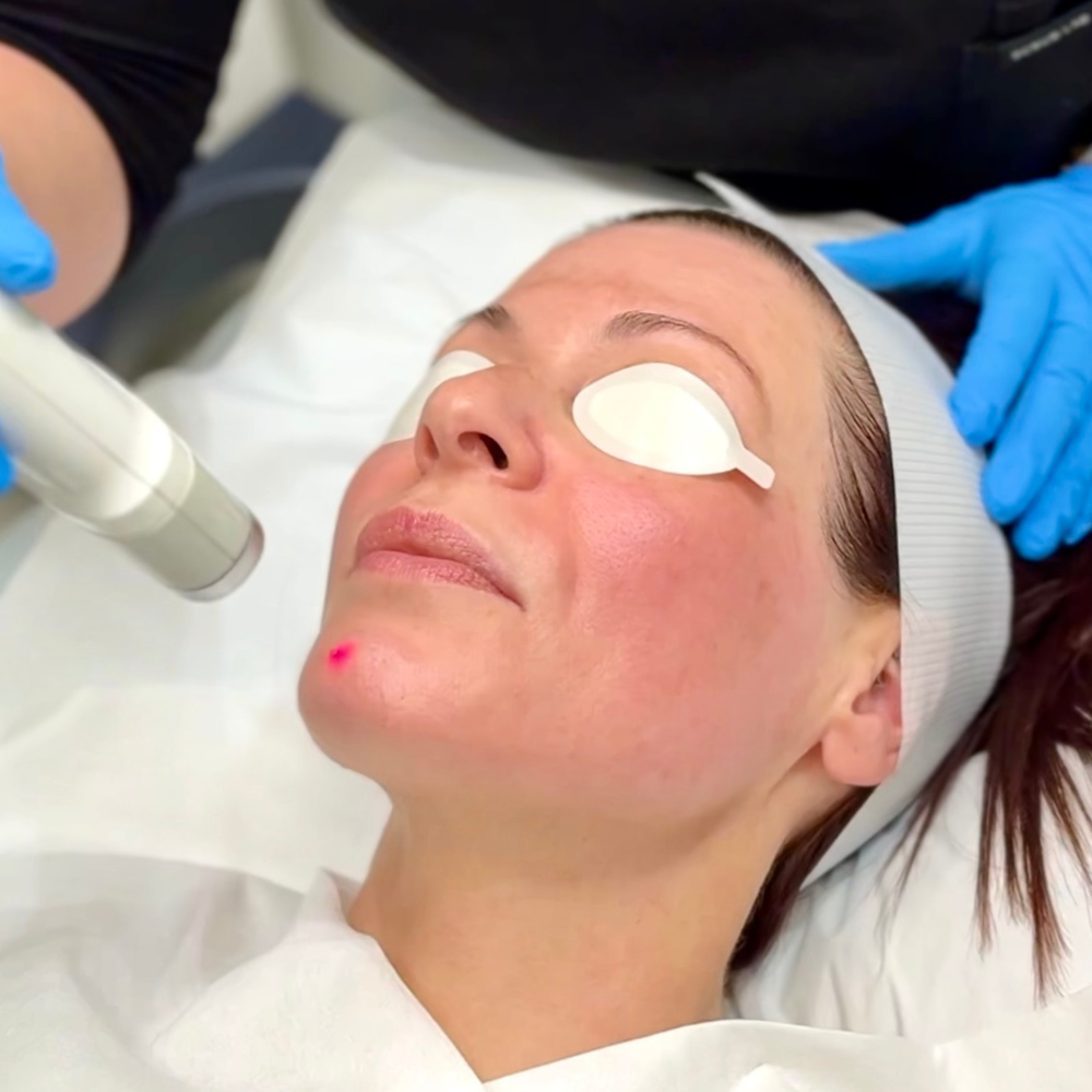 Laser Genesis™ — The Dermatology Institute of Victoria | Melbourne ...