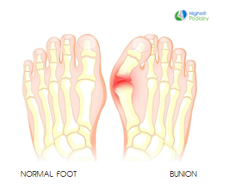Bunion Treatment — Highett Podiatry - Highett and Mentone