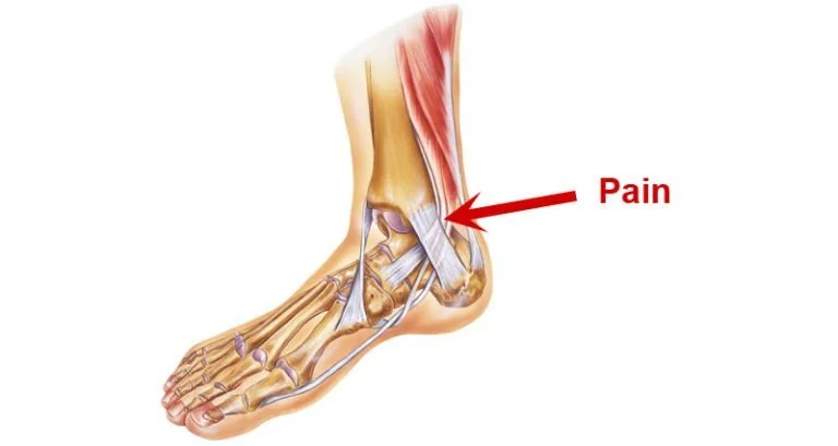 POSTERIOR TIBIALIS Tendon Dsyfunction — Highett Podiatry - Highett and ...