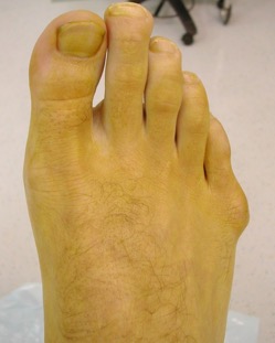 Tailor’s bunions — MJ Taranto Podiatric Surgeons
