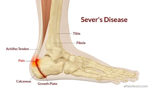 Sever's Disease: Causes & Treatments | GC Foot Centres
