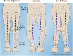 Knocked Knees (Genu Valgum): Causes & Treatments | GC Foot Centres
