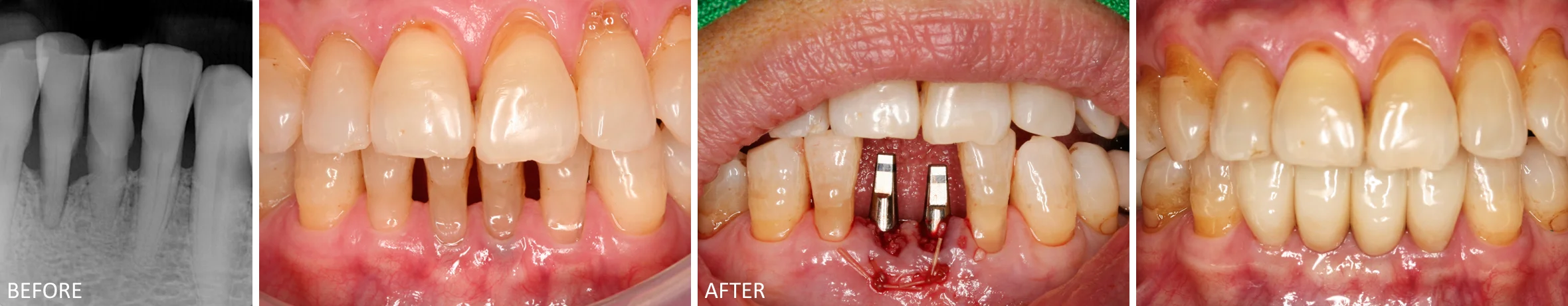 Implants — Dr. Daniel Cheng, DDS